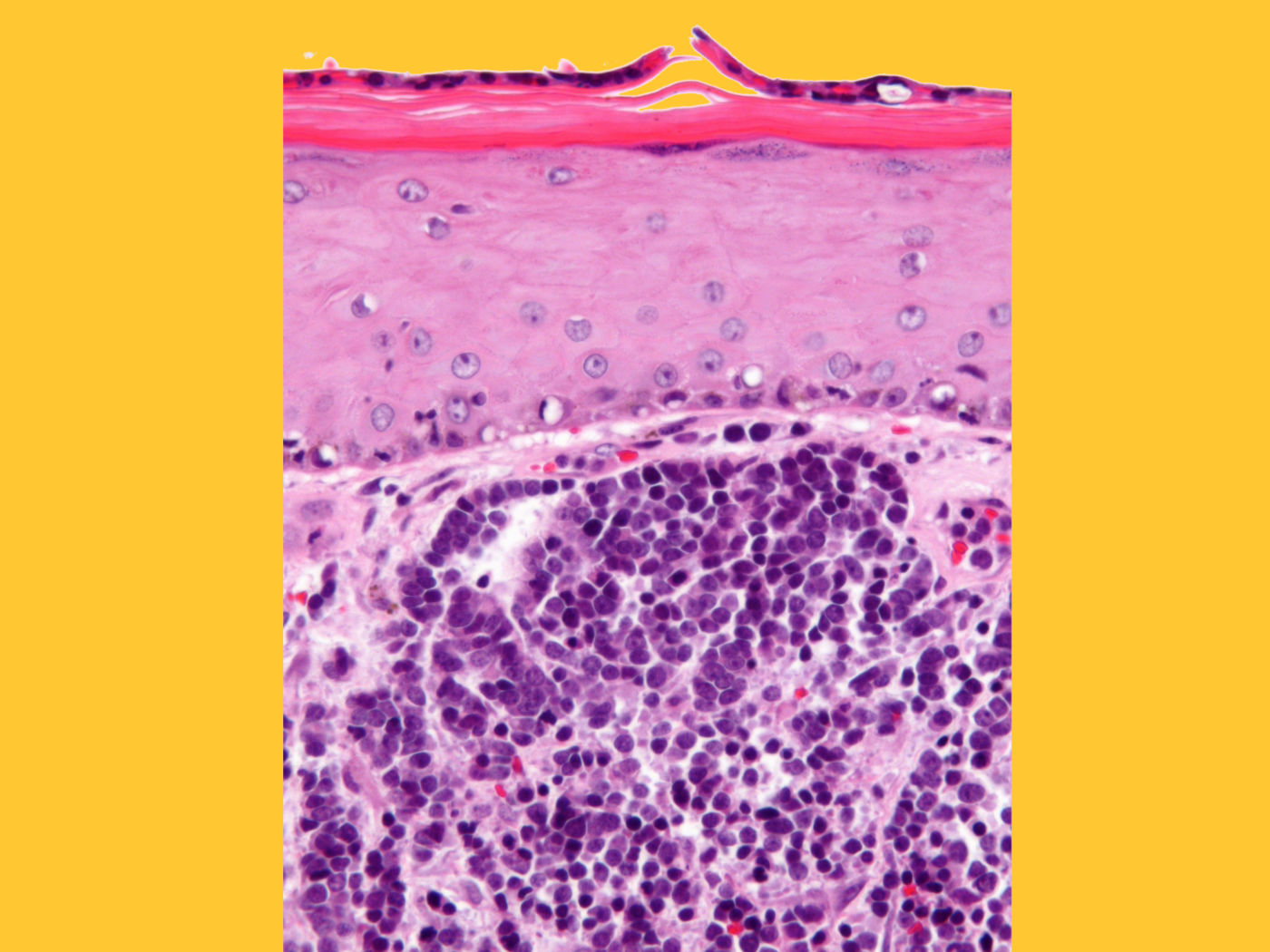 Merkel Cell Carcinoma