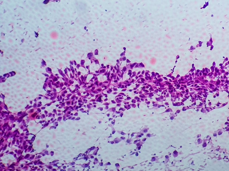 FDA Approves TEPMETKO