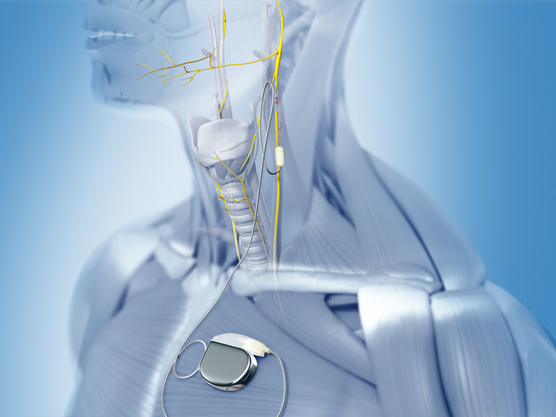 Bioelectronics BBraun Neuroloop